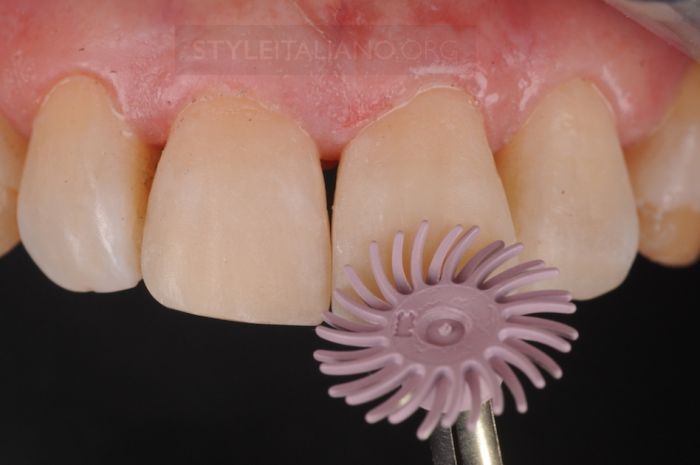 Restoration using the “one shade” technique