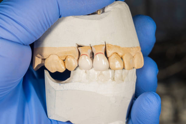 3D Micro-CT Analysis of Ancient Maya Dental Inlays