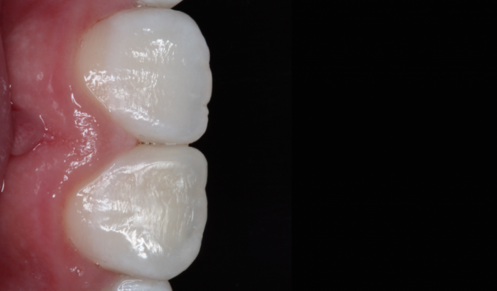 Layer-by-layer technique for creating aesthetic restorations