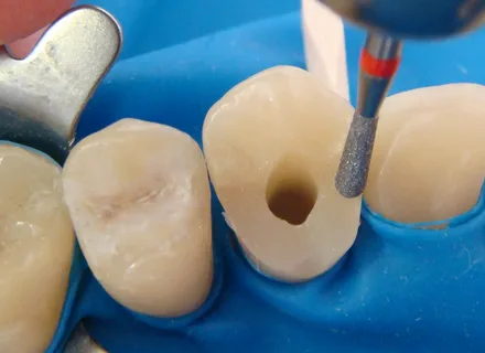 Opening of the tooth cavity. Endodontic access