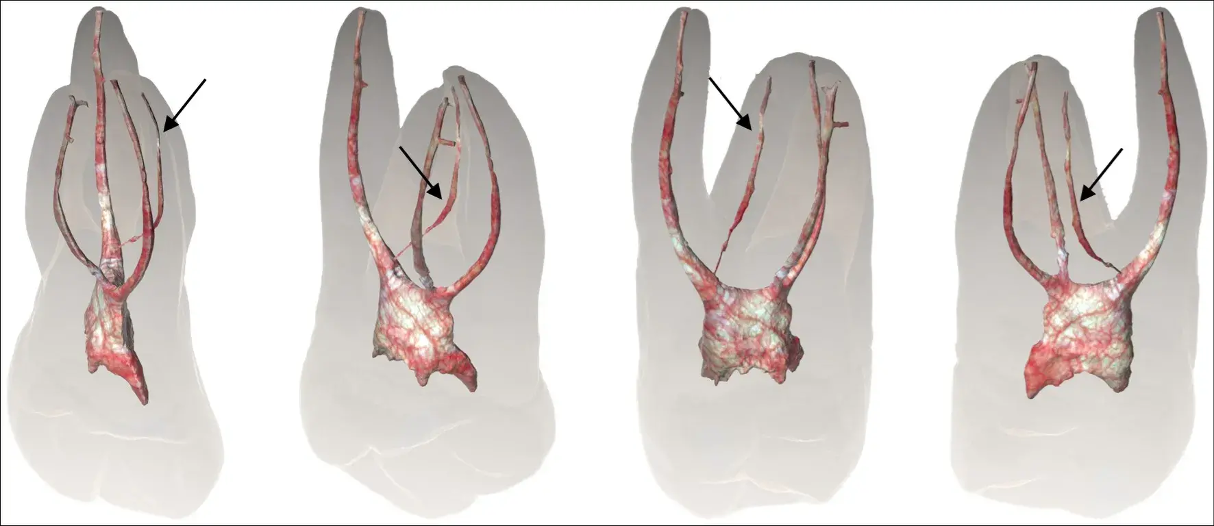 Undiscovered Anatomical Structure in Maxillary Second Molars