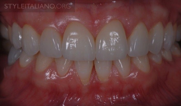 Ausbildung zum Thema Bugel prosthesis