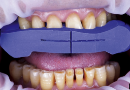 Silicone key device for maxilla orientation