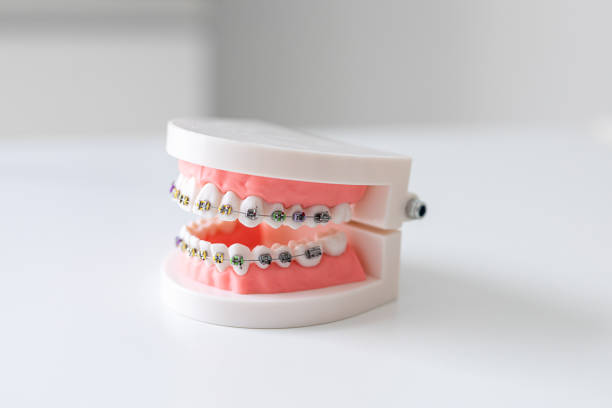 Retention in Orthodontics. Retention Appliances: Fixed and Removable ...