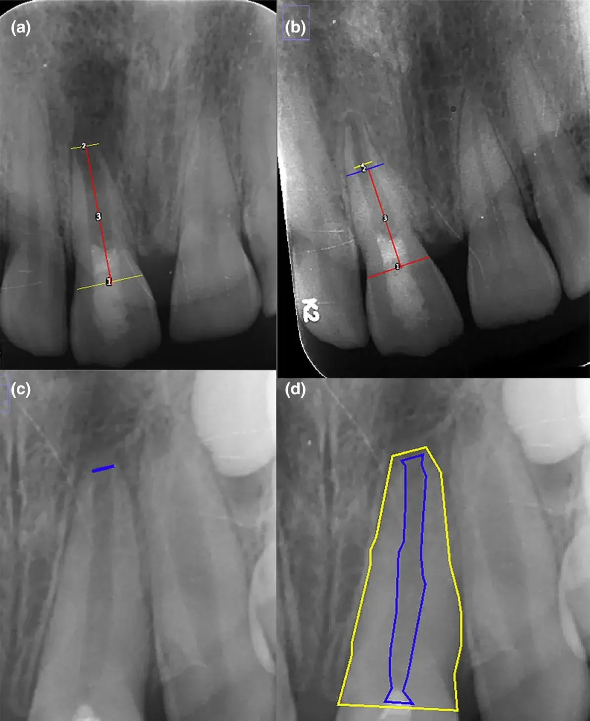 The effect of PRF in regeneration/revitalization endodontics