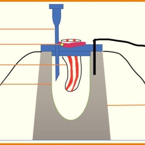Impact of Root Canal Therapy Techniques on Apical Debris Extrusion
