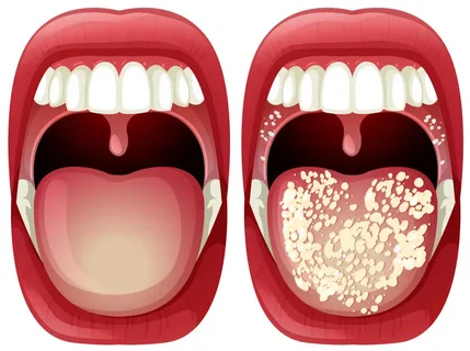 Manifestaciones de micosis en la cavidad bucal. Estomatitis por Candida