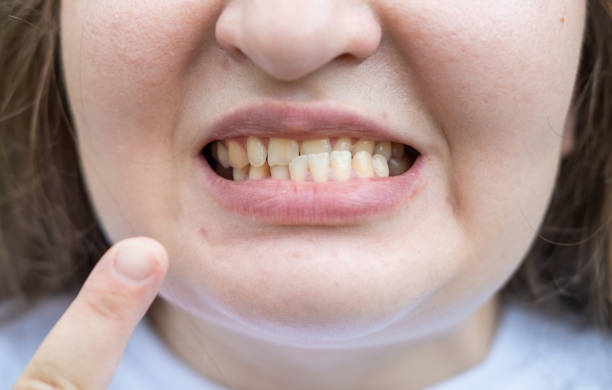 Disorders of Physiological Occlusion of Dental Arches