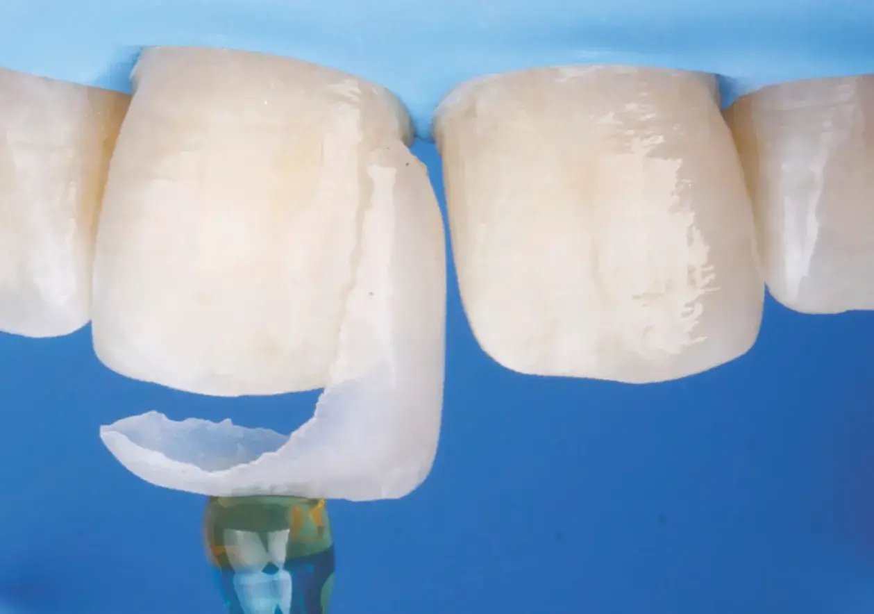 MIRA: A 10‑Step Minimally Invasive Restorative Protocol