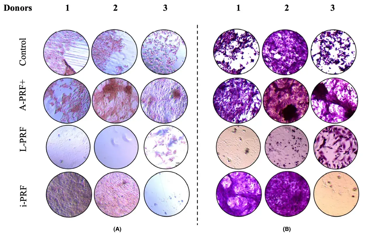 Prf Preparations For Osteogenesis A Prf I Prf And L Prf