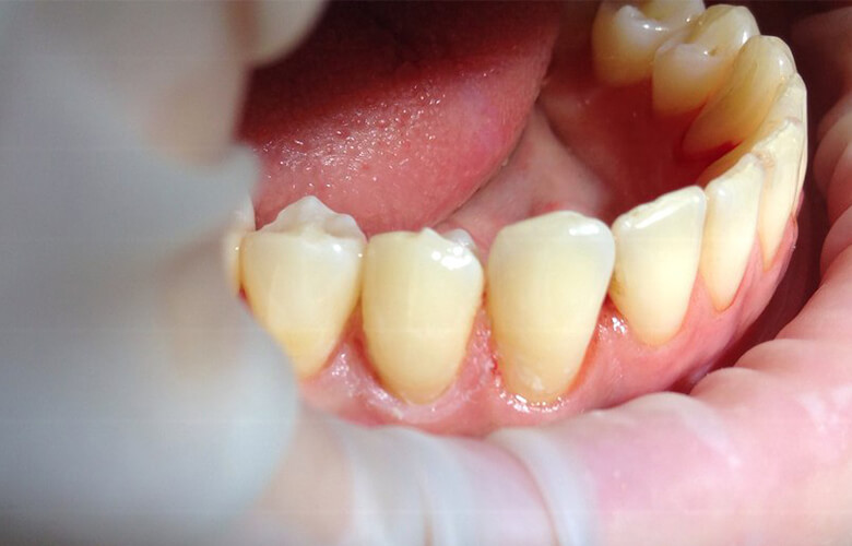 Pericervical restoration and gingivectomy