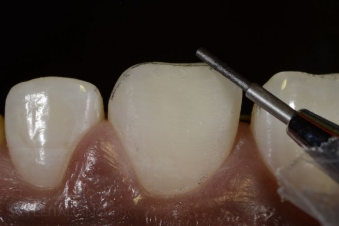 The Power of Pencil in Front Teeth Composite Restorations