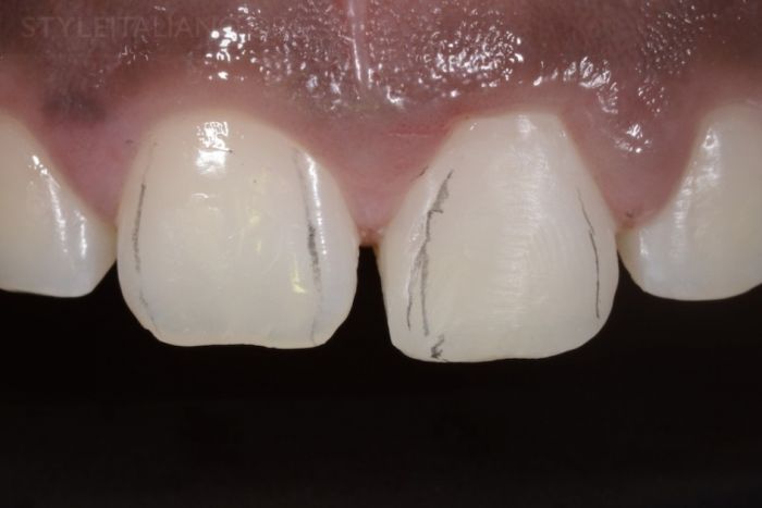 The Power of Pencil in Front Teeth Composite Restorations