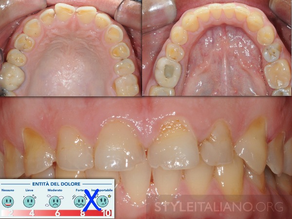 Increased dentin sensitivity