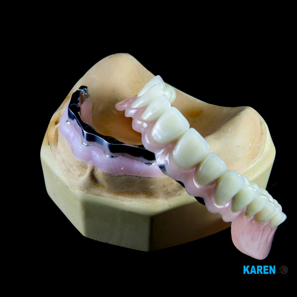 Clasp denture fixation systems