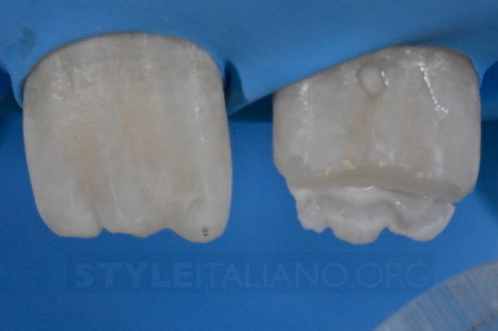 Treatment of crown fracture within enamel and dentin