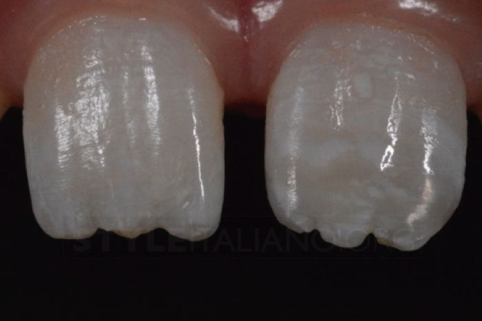 Treatment of crown fracture within enamel and dentin