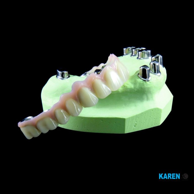 Clasp denture fixation systems