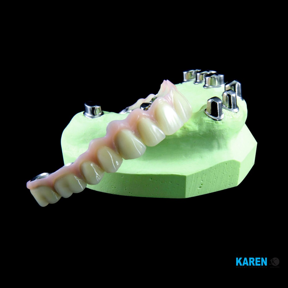 Clasp denture fixation systems