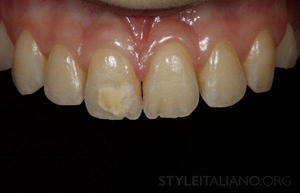 Minimally Invasive Treatment for Tooth Stains