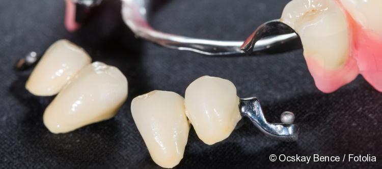 Clasp denture fixation systems