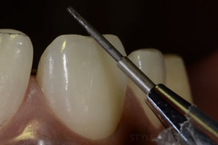 The Power of Pencil in Front Teeth Composite Restorations