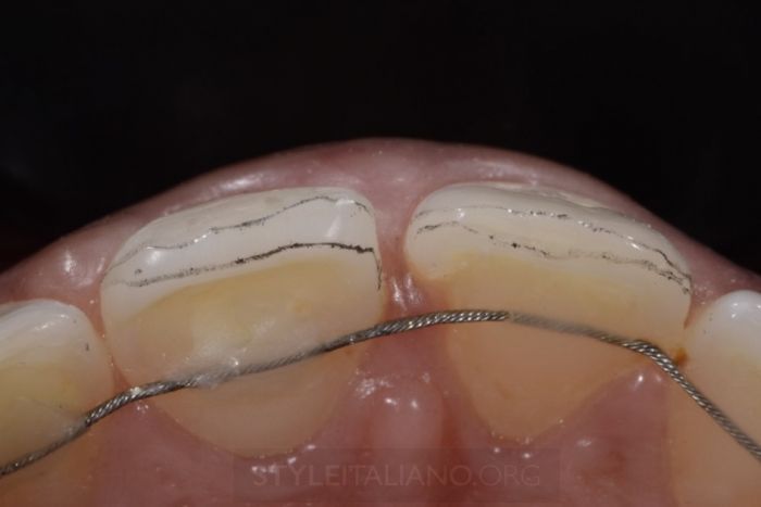 The Power of Pencil in Front Teeth Composite Restorations