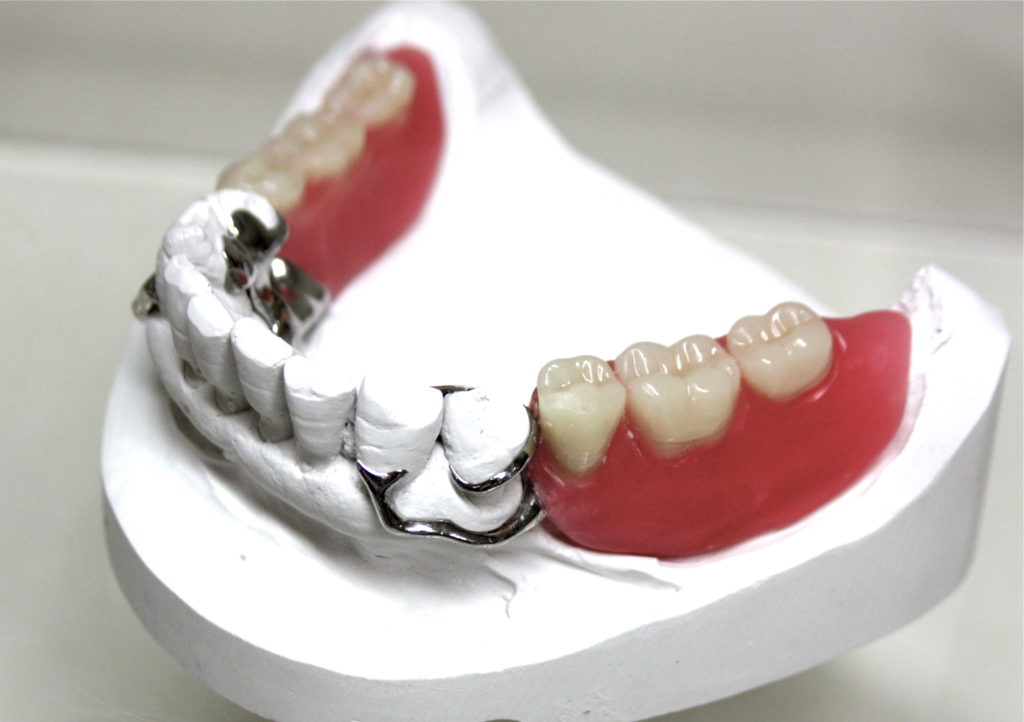 Clasp denture fixation systems