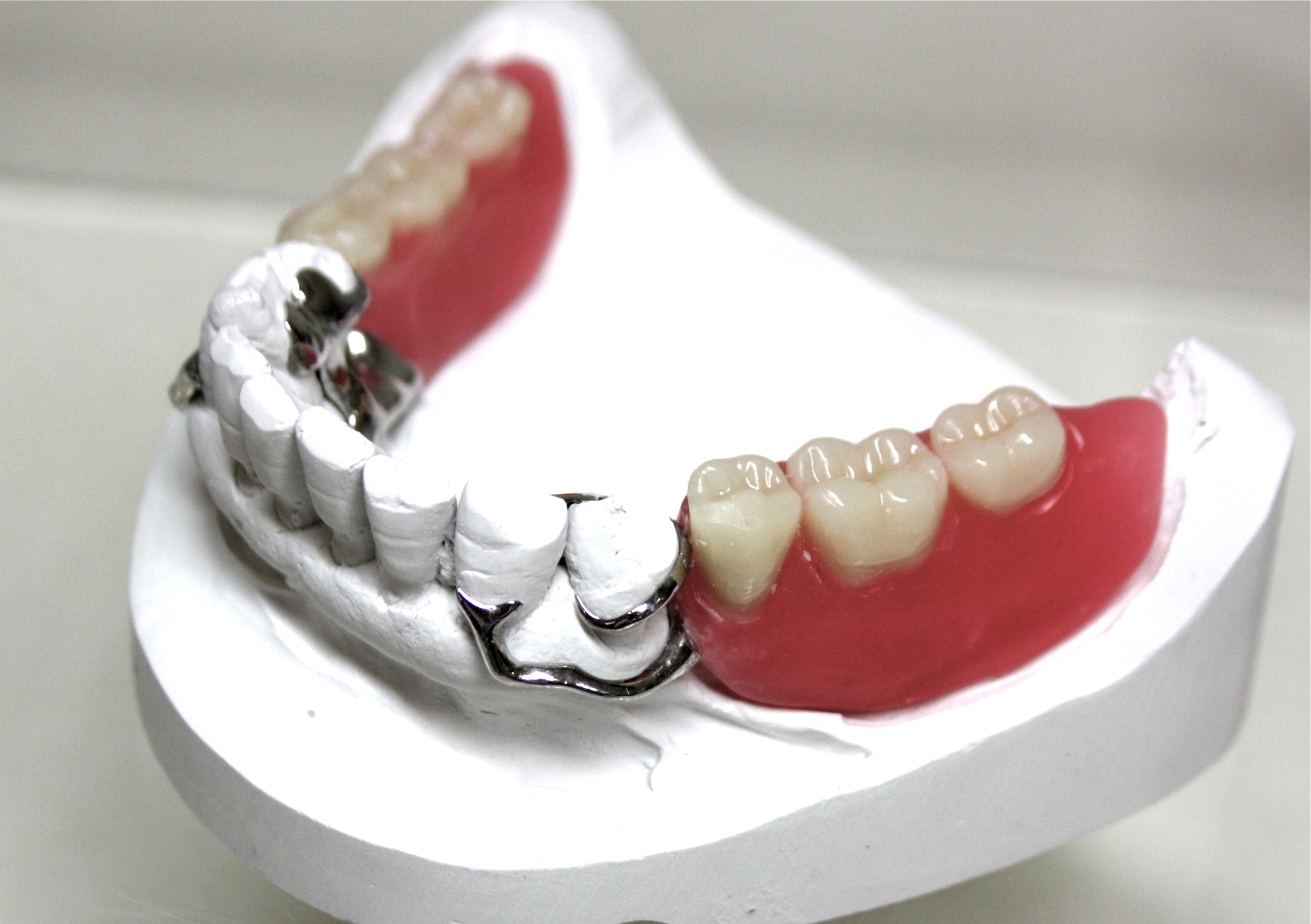 Clasp denture fixation systems