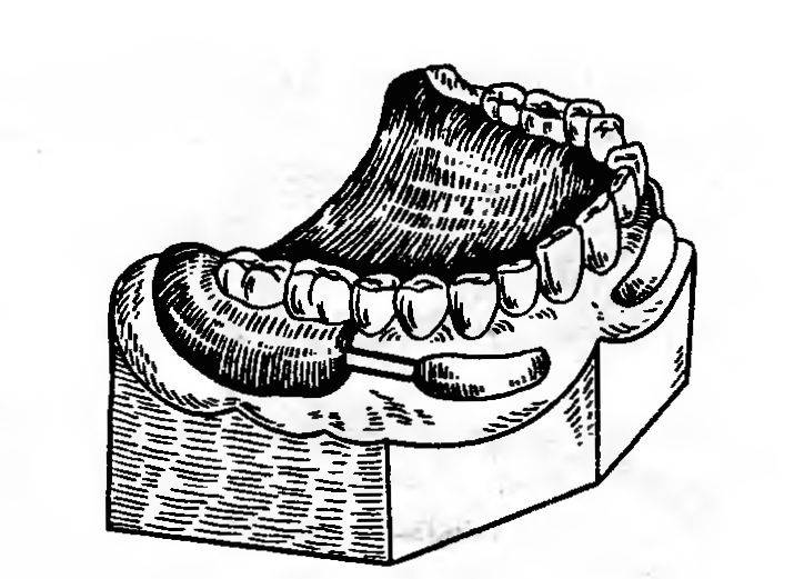 Фиксация Полных Съемных Протезов Факторы их стабилизации