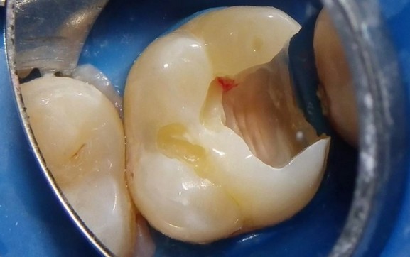 Pulp therapy for primary teeth. When? How?