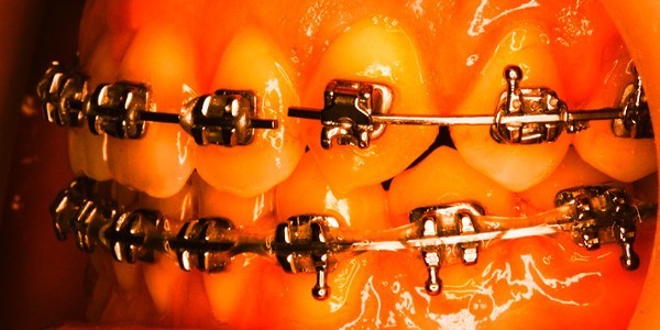 Signs Indicating for Orthodontic treatment