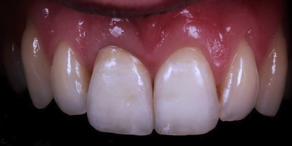 The bio-emulation protocols for shade matching in dentistry