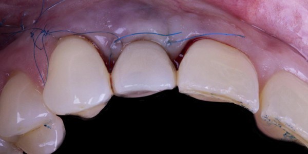Implant-Perio Evolution 2.0: Biological Bone Augmentation and the ...