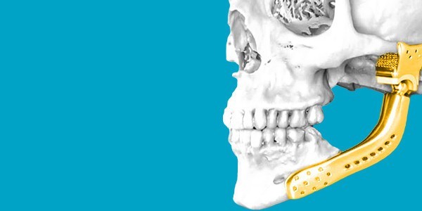 TMJ Surgery – Part 2: TMJ Pathologies Requiring Total Joint Replacement