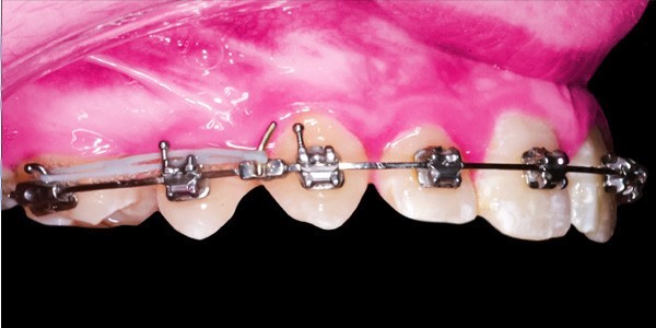 Non-extraction treatment of Class II