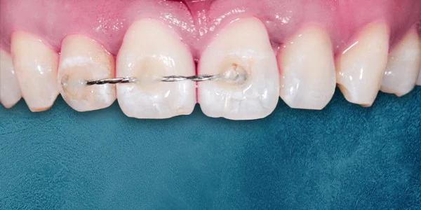 Management of Horizontal Root Fractures