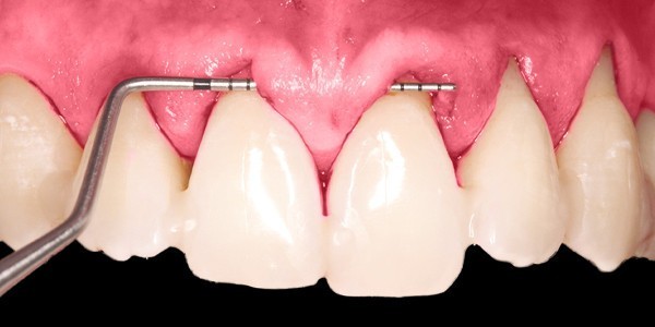 Clinical concepts for regenerative periodontal surgery in intrabony and ...