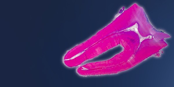 Deep caries lesions and exposed pulp. Can “vital pulp therapy” measures ...