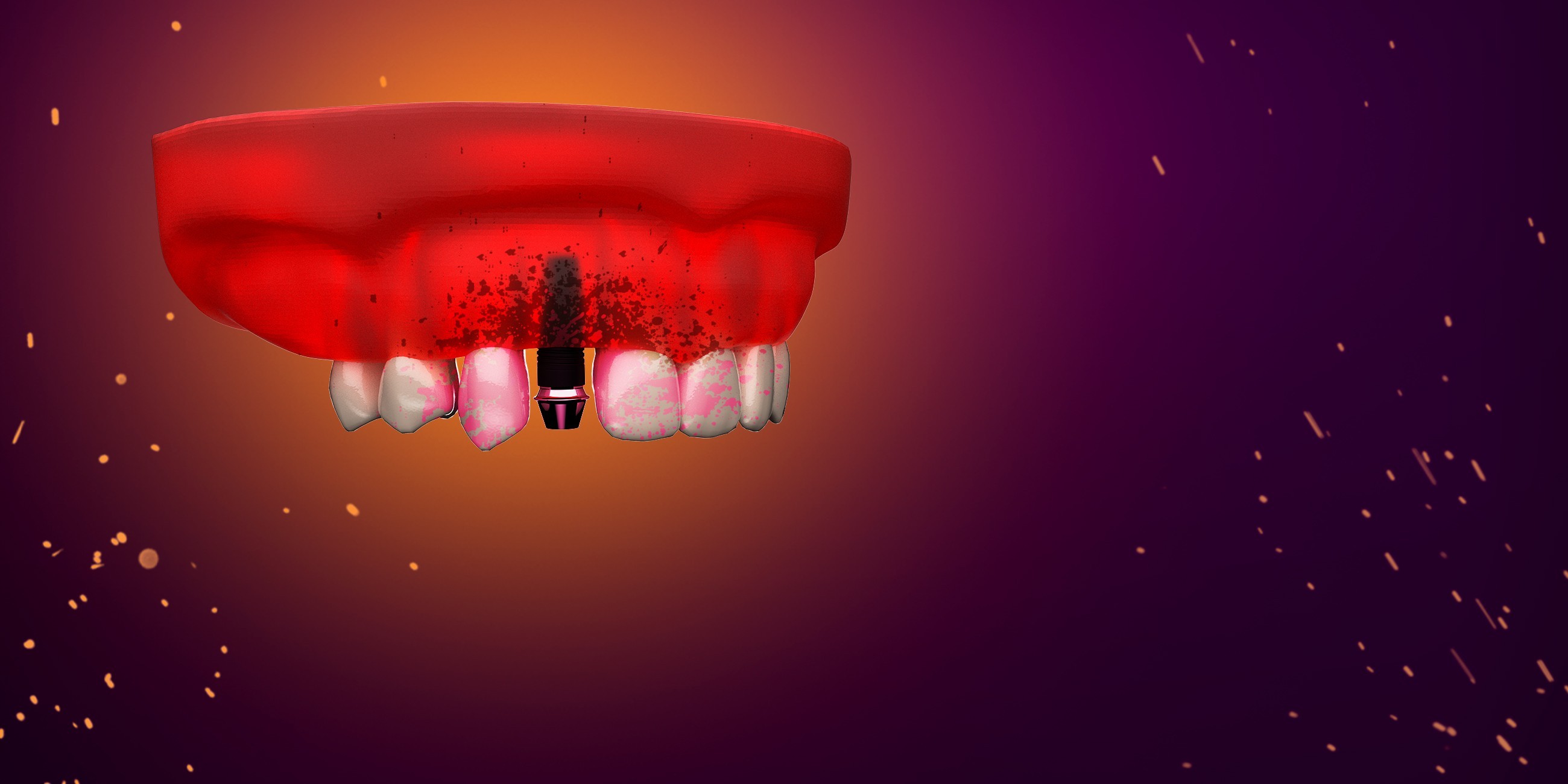 Crestal Sinus Lift Course – An efficient and predictable approach for ...