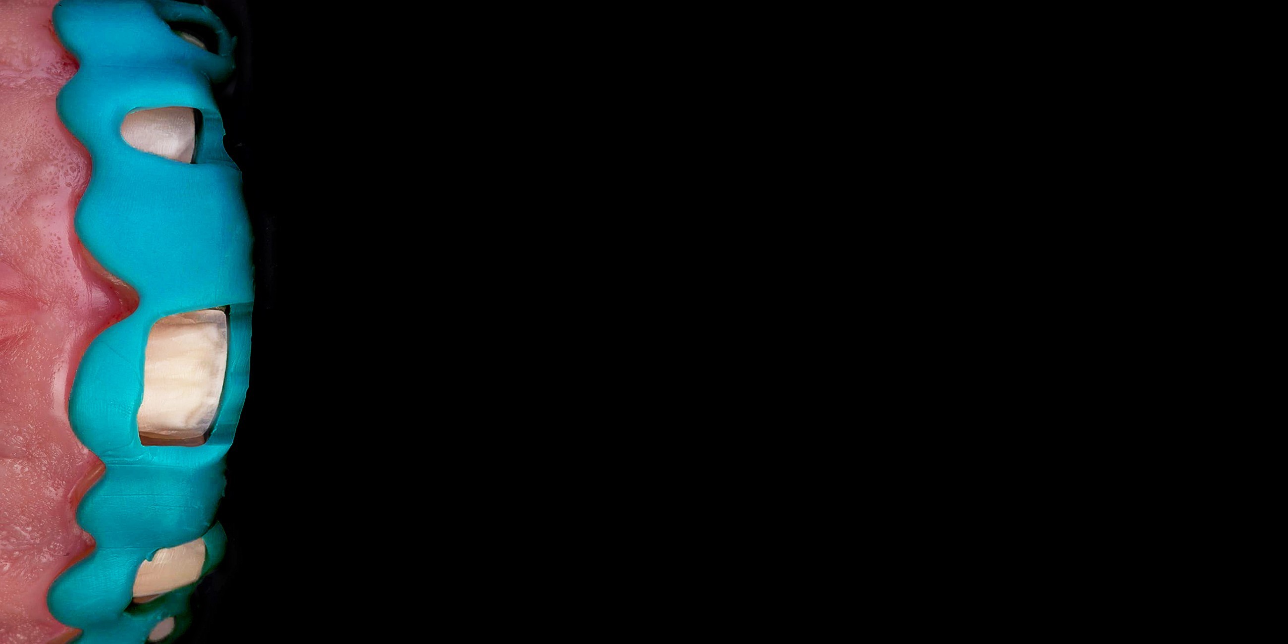 Online lesson on Bonded Functional Esthetic Prototype (BFEP)