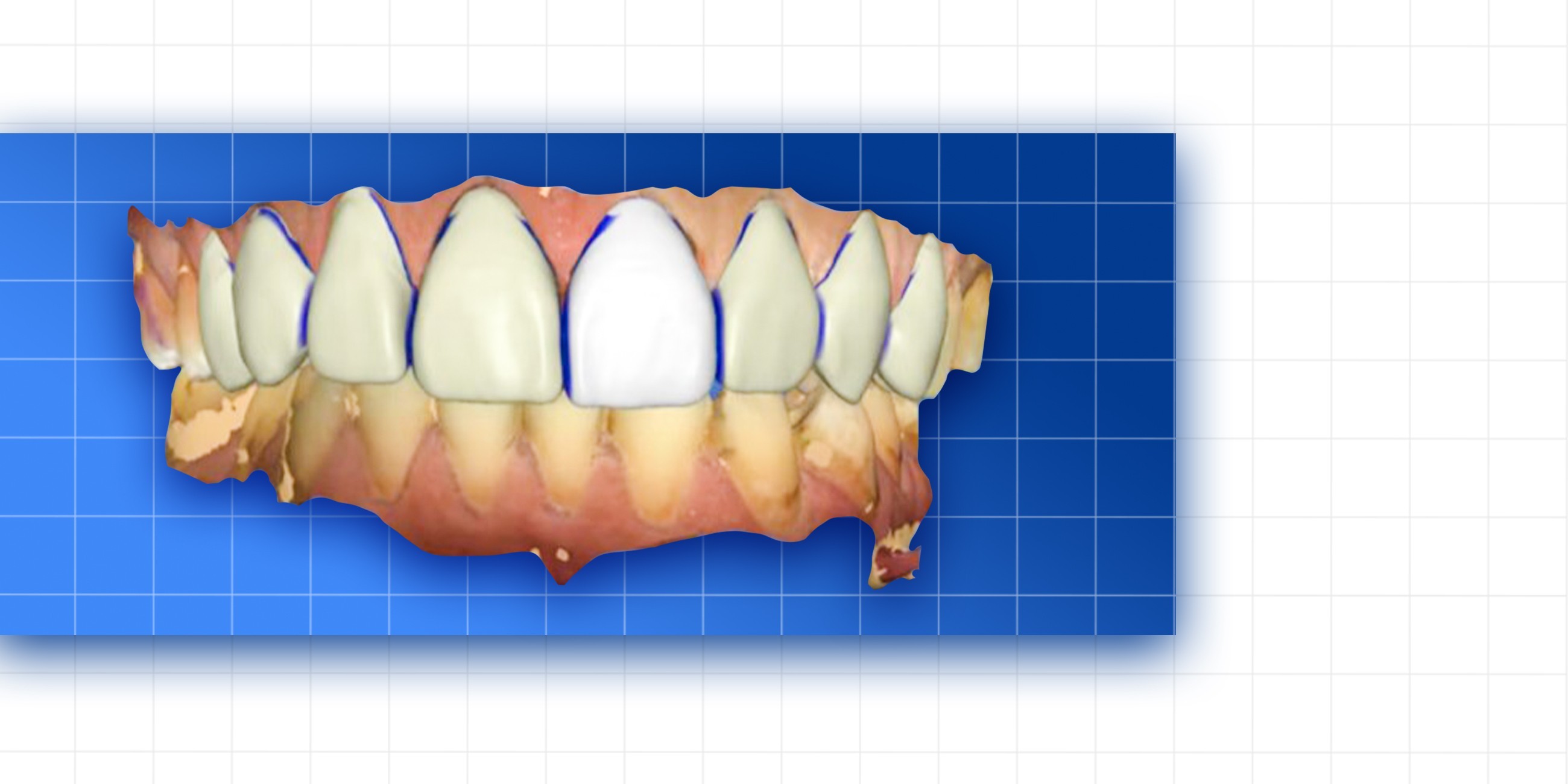 Teeth preparation protocols