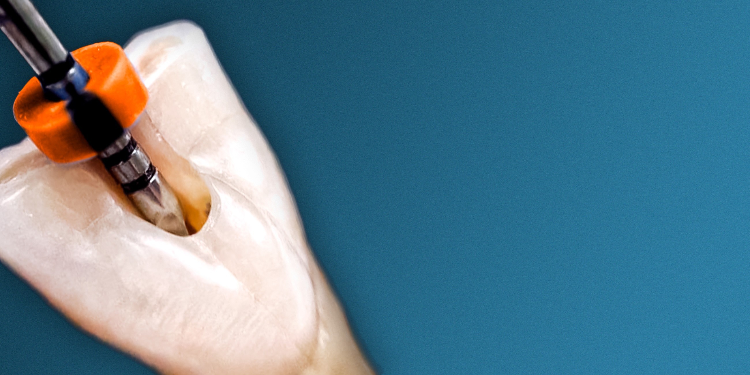 Webinar on root perforations, perforation treatment, CBCT