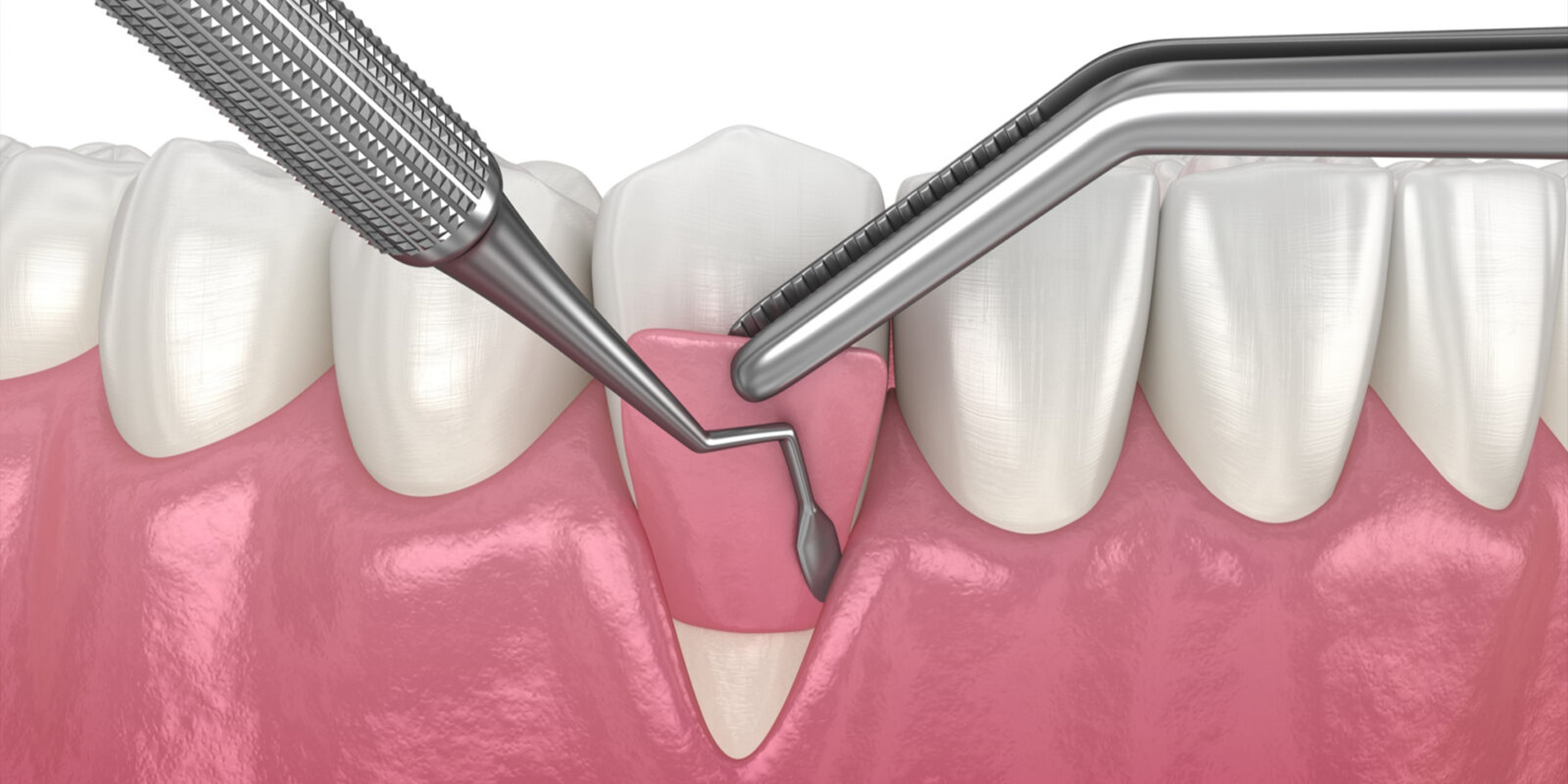 Webinar on peri-implant plastic surgery, peri-implant mucosa