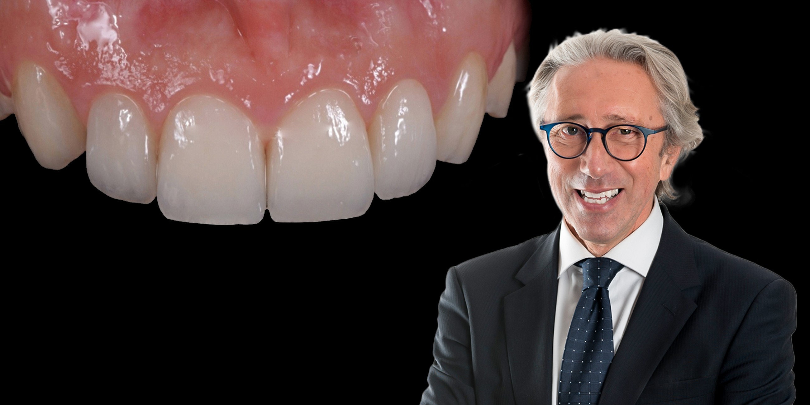 Webinar on functional optimization technique, cross mounting