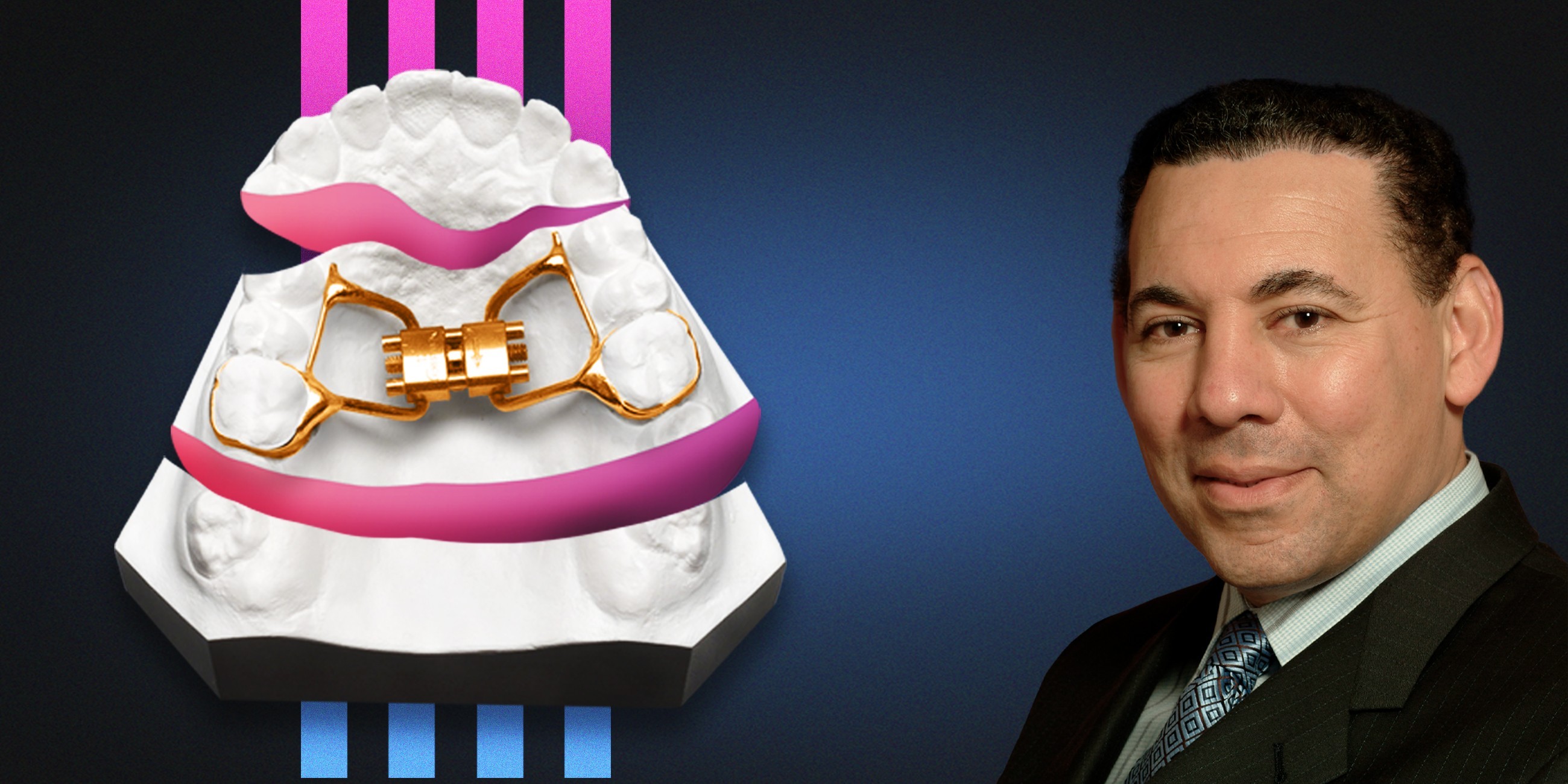 Webinar on retention, relapses in orthodontics, fiberotomy