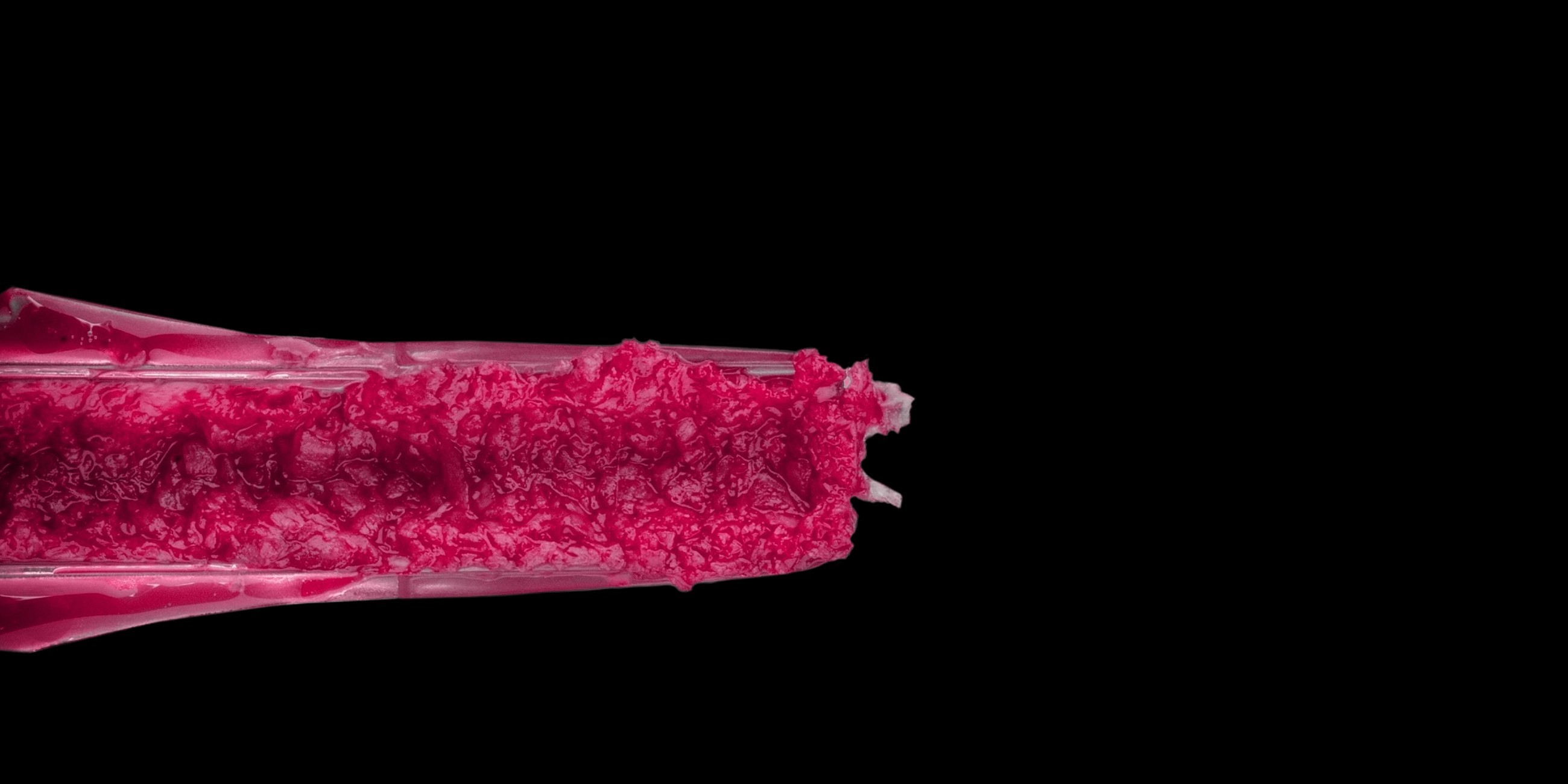 Bone augmentation with allograft