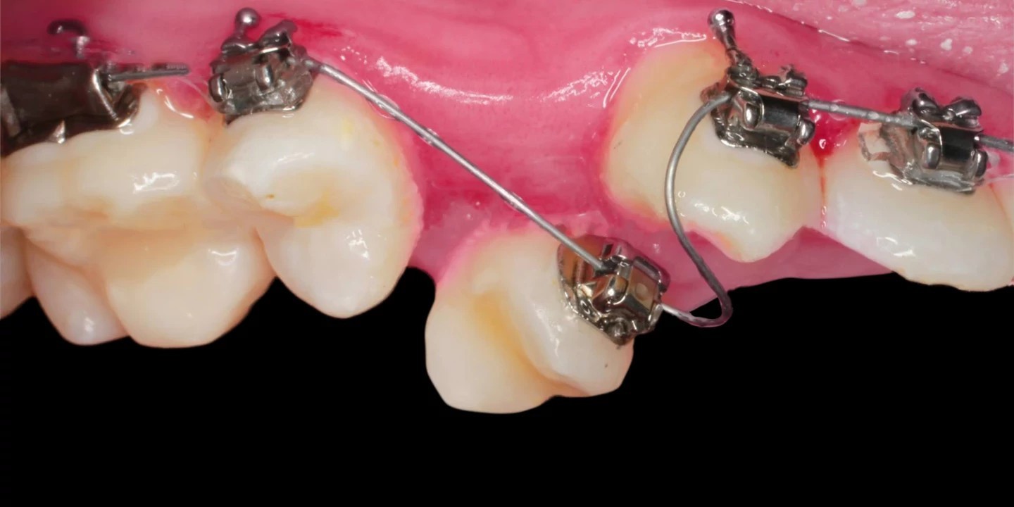 OrthoEvolution 2.0. Clinical Management of Transpositions in ...