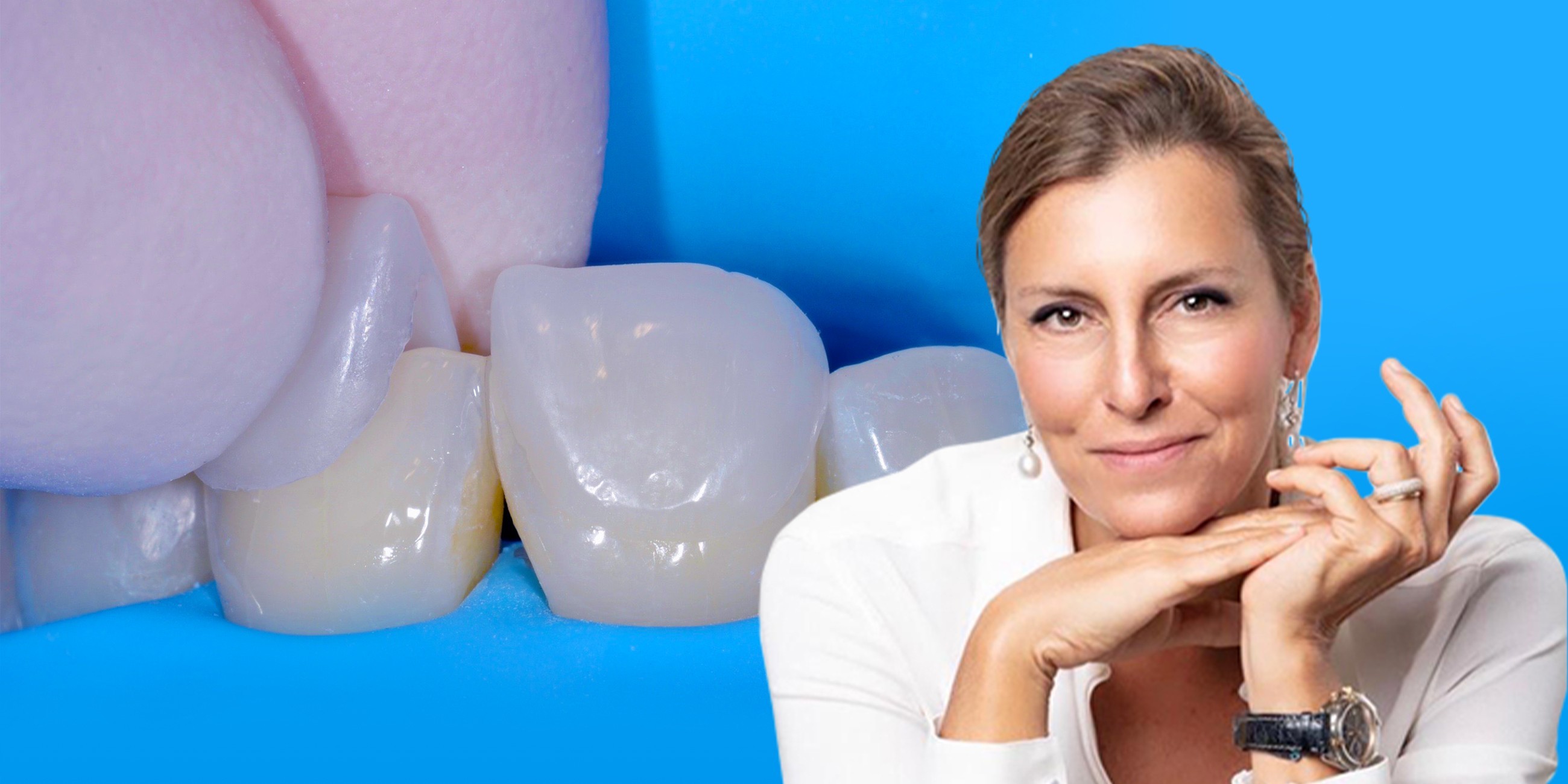 Trattamento dell'erosione dentale secondo la tecnica 3STEP di Francesca Vailati