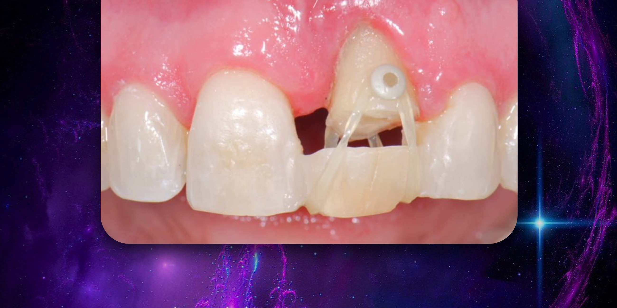 Surgical crown lengthening and vertical preparation to recover severely ...